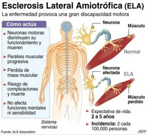 Enfermedad ELA; Nuevo ensayo clínico en Murcia y Alicante.